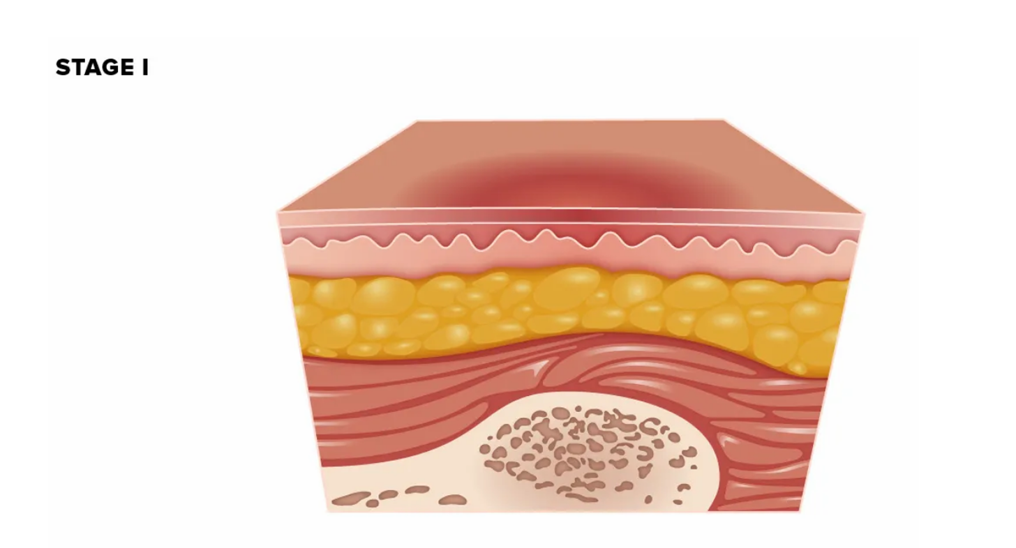 Wound Care Hub | Pressure Ulcer Staging & Wound Healing Guide