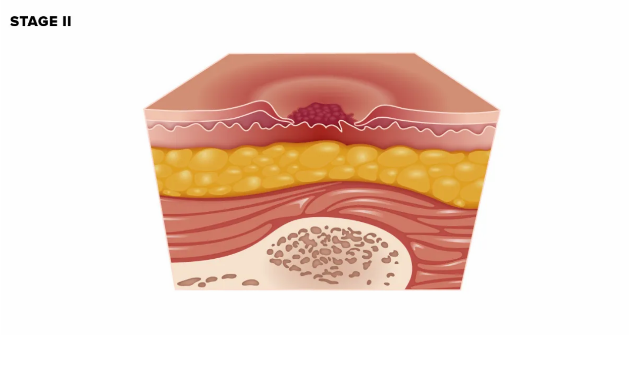Wound Care Hub | Pressure Ulcer Staging & Wound Healing Guide